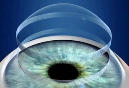 All you need to know about Corneal Transplant - TebMedTourism